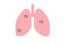 Tuberculosis | Pueblo County
